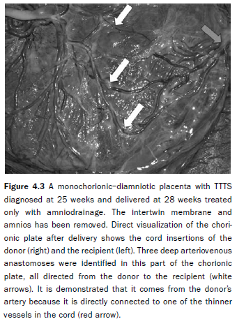 Placenta | Twin-Twin Transfusion Syndrome (TTTS)