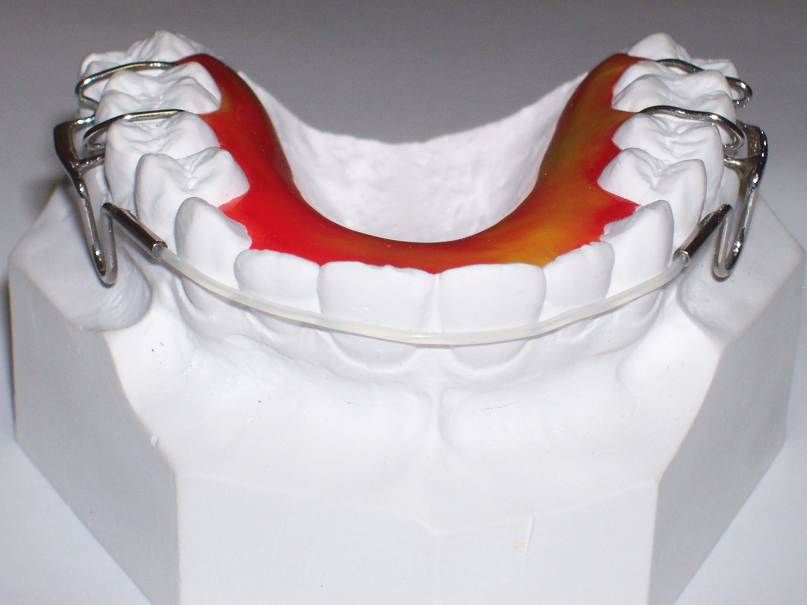 Вестибуларни дъги ~ Медико-техническа ортодонтска лаборатория "Ortho Lab"