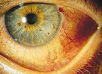 Health Article: Scleritis