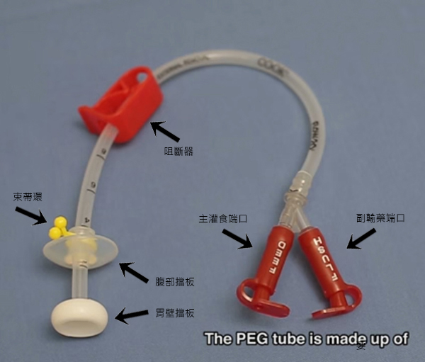 第一次胃造口常見的PEG款式 ~ 胃造口使用者經驗