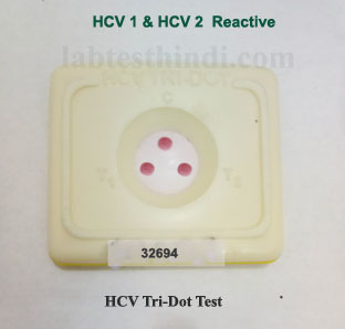 Hepatitis C ( HCV ) Test कैसे करते है ~ Lab Test Hindi
