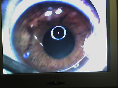 LASIC : What You Should Know About LASIK: What Is Lasik And Lasek Surgery?