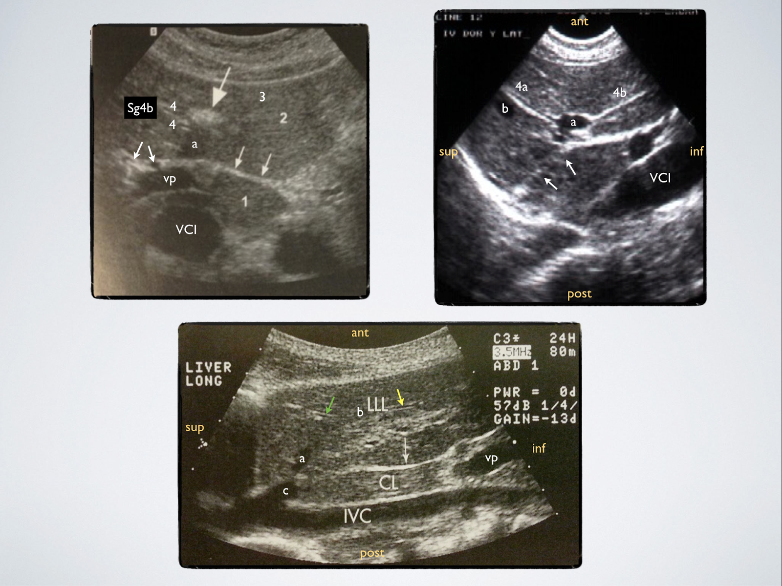 Cuadernos de Anatomía Quirúrgica: Segmentación hepática en ecografía.