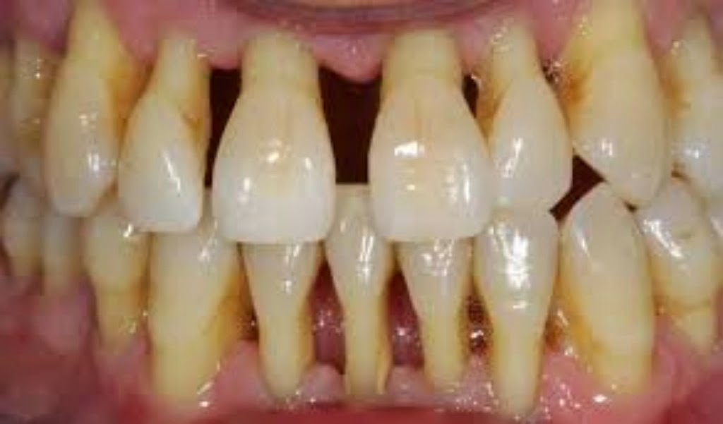 Мој стоматолог: Значење на пародонтопатиите