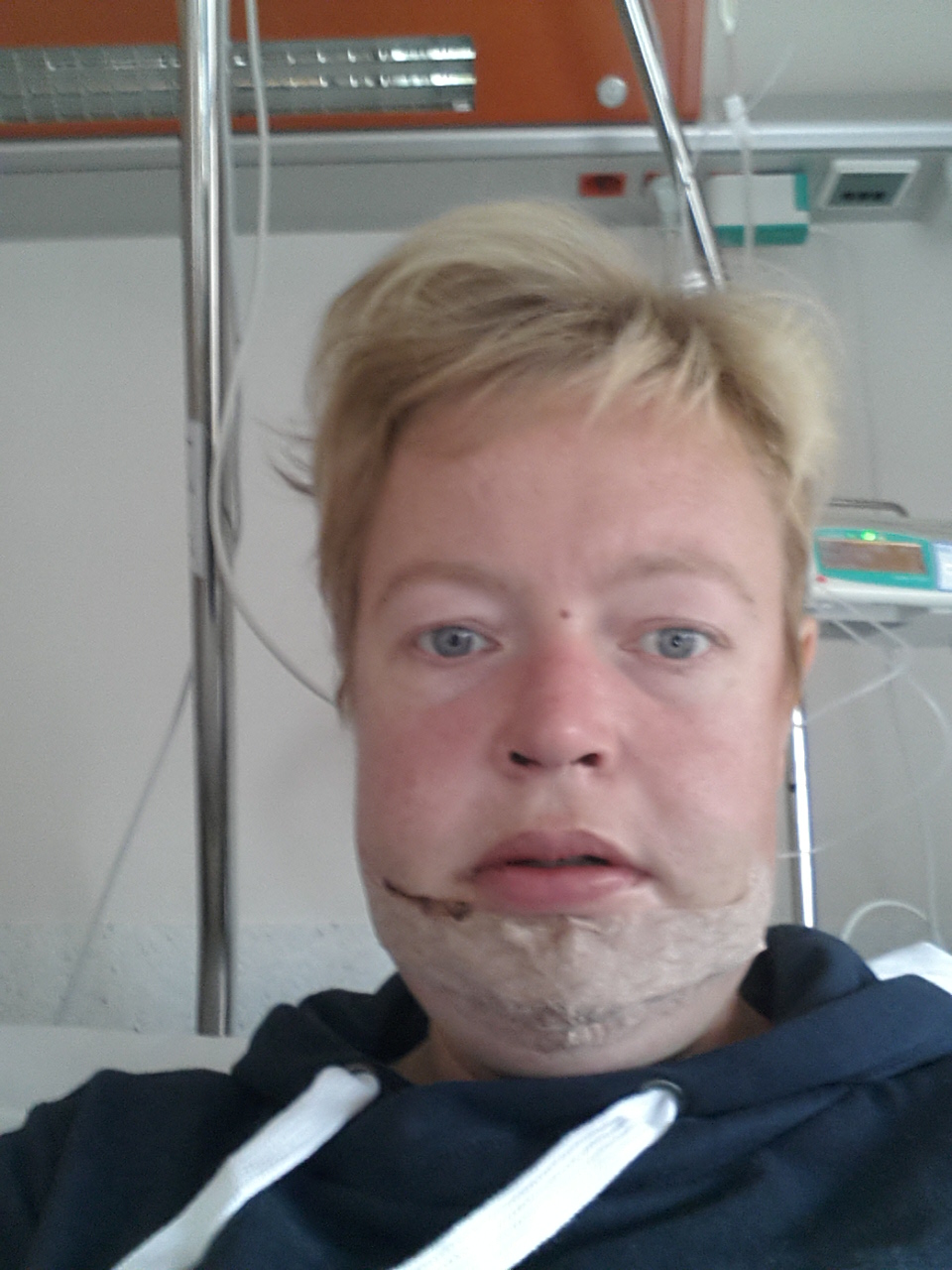 Joke's kaakoperatie: Bijna 9 weken na de operatie