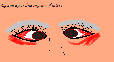 Panda sign | Panda sign in head injury - PHYSIO STUDY