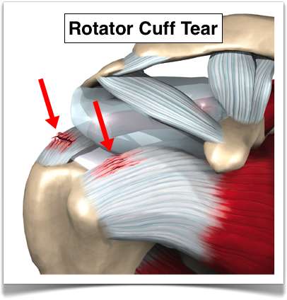 Rotator cuff injuries problem and cause ~ akufisio.blogspot