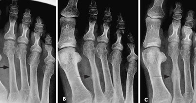 Case of the Day: March Fracture