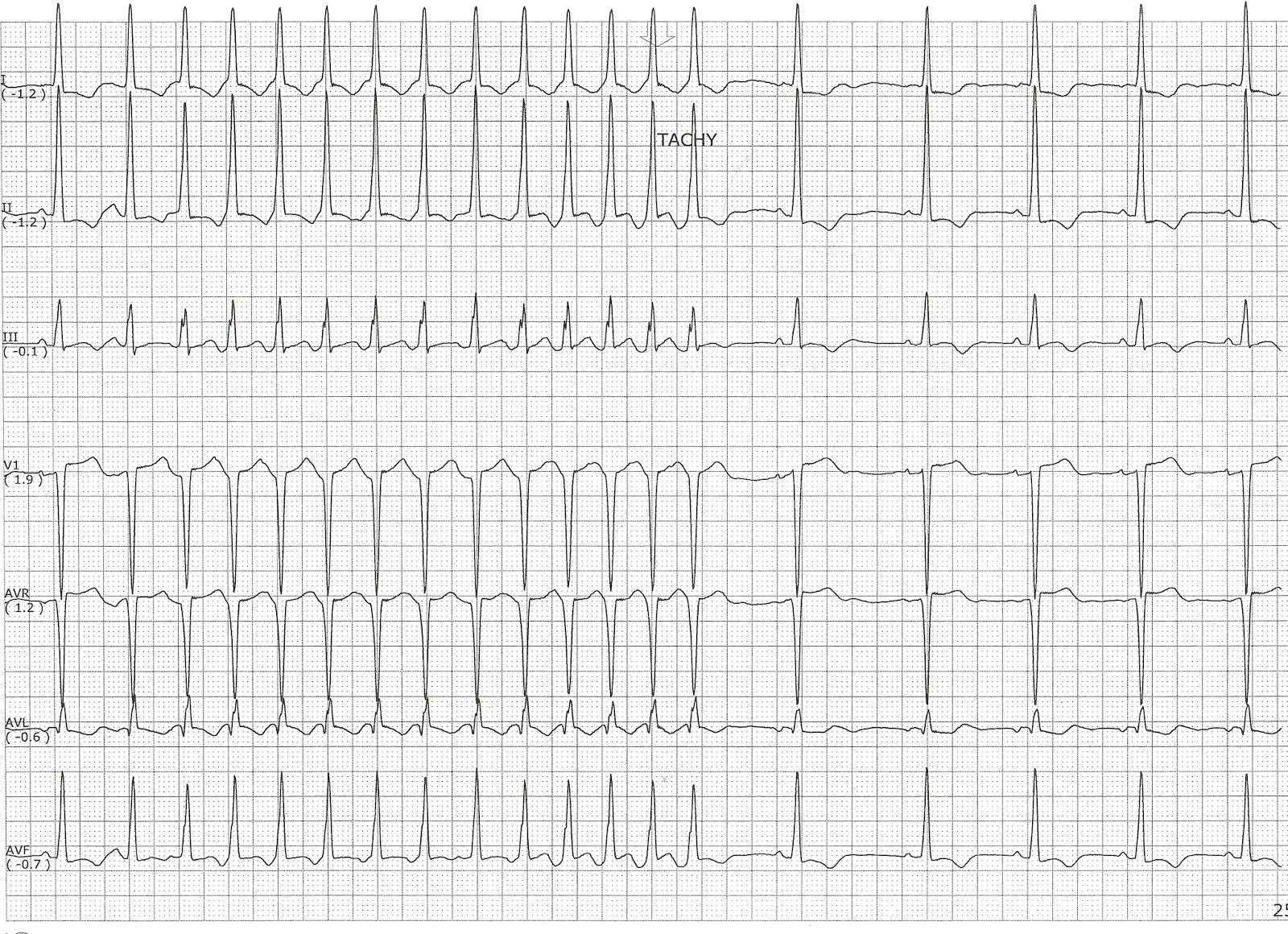 Float Nurse: Run of SVT