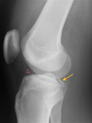 MedView Medical Imaging Consultancy Info Page: Avulsion fracture