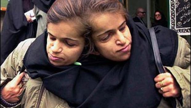 Ladan and Laleh Bijani, 29-year-old Iranian joined twins died during ...