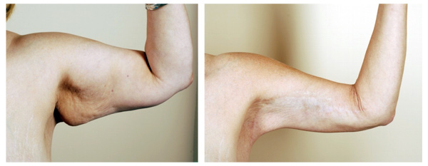 Plastic Surgery Before And After: Arm Lift