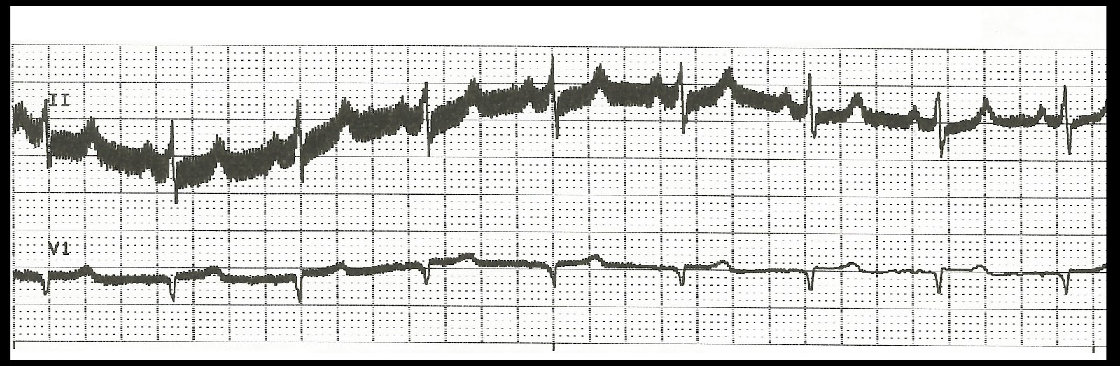 Practice ECG Rhythm Strips 129