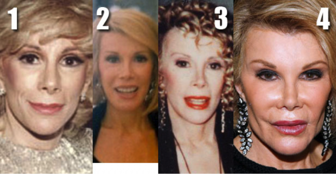 Joan Rivers Plastic Surgery Facelift, Nose Job Before and After Photos