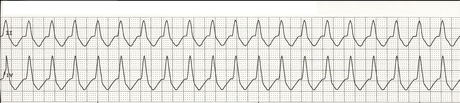 ACLS Rhythms: Ventricular rhythms