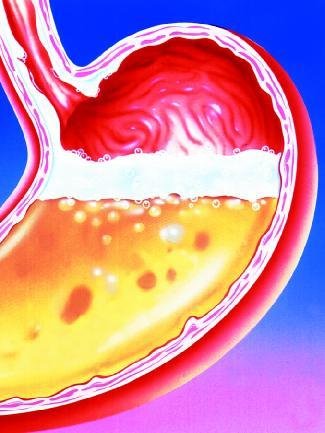 Obat Asam Lambung Tradisional ~ Obat Diabetes Kering Berkualitas