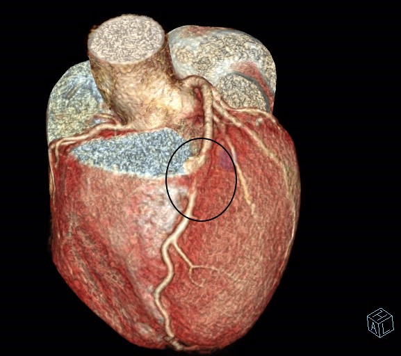Myocardial Bridging on CT @Universal - Dr. Shanavaskhan Shamsudeenkutty ...