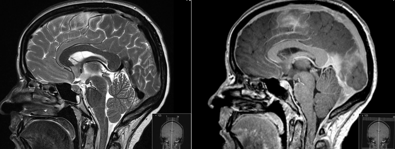 CSF Leakage - Intracranial Hypotension