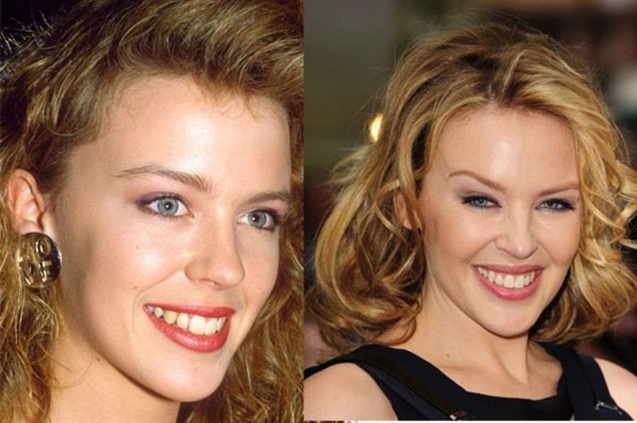 Las 10 Celebrities mejor operadas, descubre su antes y el después