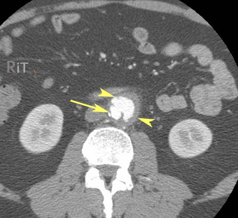 RiT radiology: Infected (Mycotic) Aortic Aneurysm