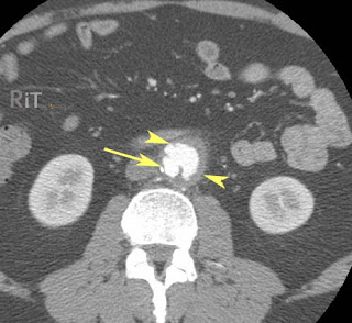 RiT radiology: Infected (Mycotic) Aortic Aneurysm