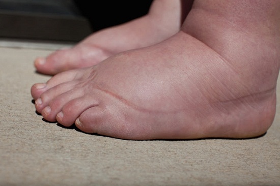 SUMBER ILHAM: PETUA ATASI KAKI BENGKAK