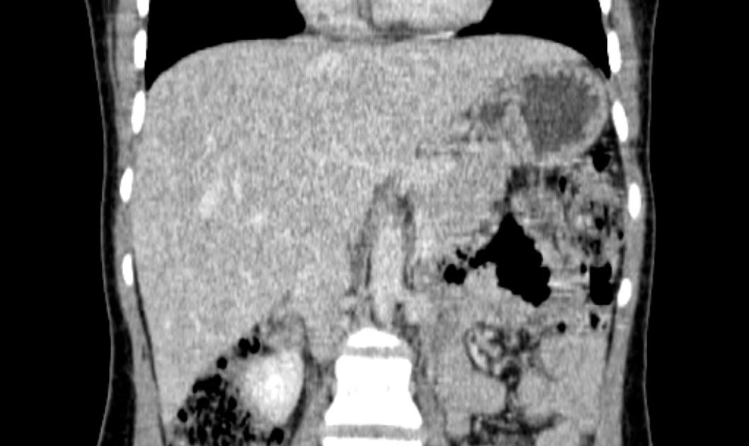 Ultimate Radiology : Pseudolesion : Papillary Process of Caudate Lobe