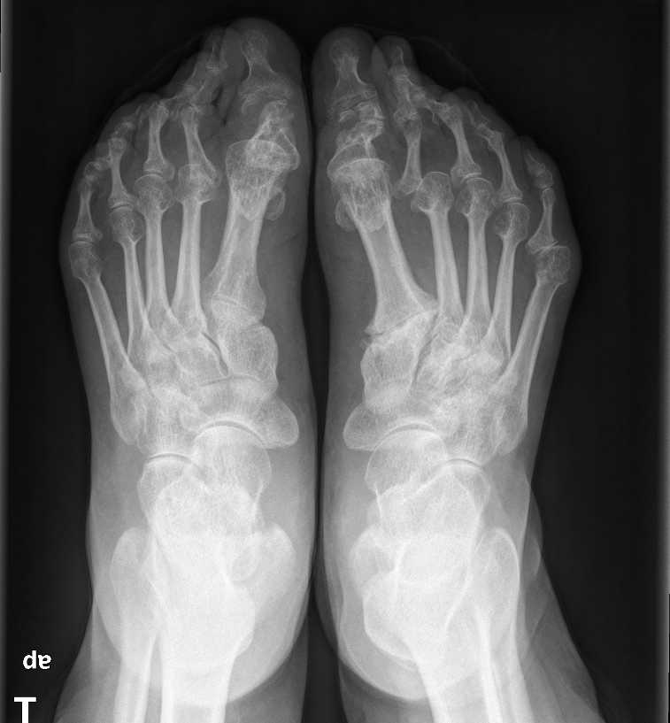 Fanáticos del pie: ATLAS DE PATOLOGÍA DEL PIE: ANTEPIE REUMATICO