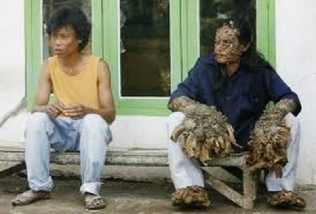 Do you remember the man tree? He had his surgery and is fine! See how ...