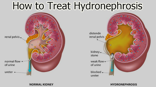 How to Treat Hydronephrosis
