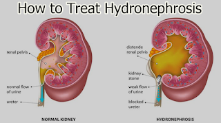 How to Treat Hydronephrosis