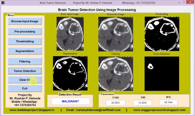 Matlab Code Brain Tumor Detection And Classification Using