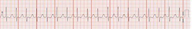 EKG Rhythm Strip Quiz 52: Heart Blocks