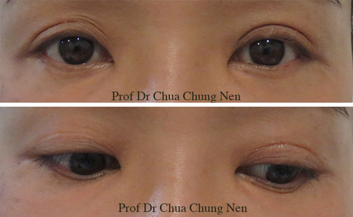 Eyelid Surgery by Prof Dr CN CHUA 蔡鐘能: Doc, why do I have so many lines ...