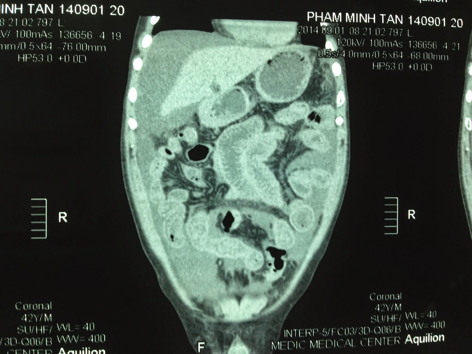 VIETNAMESE MEDIC ULTRASOUND: CASE 272: EOSINOPHILIC GASTROENTERITIS and ...