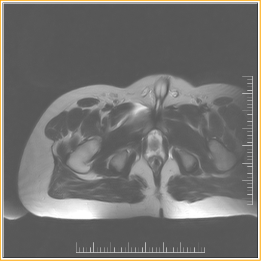 Adductor Longus Avulsion-MRI - Sumer's Radiology Blog