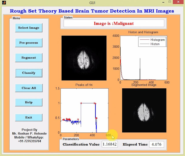 Brain Tumor Detection On Dicom Images Using Rough Set Theory Matlab Project With Source Code