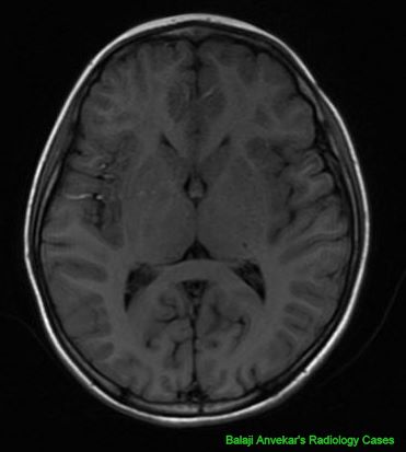Dr Balaji Anvekar FRCR: Dot sign in MCA thrombosis