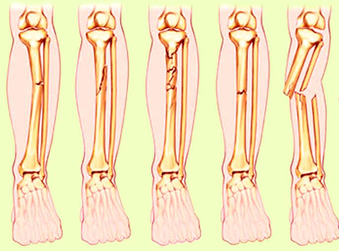 One For All: Kelainan dan Gangguan pada SISTEM ALAT GERAK