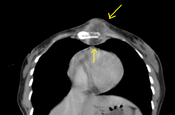 Sternal Tuberculosis-CT - Sumer's Radiology Blog