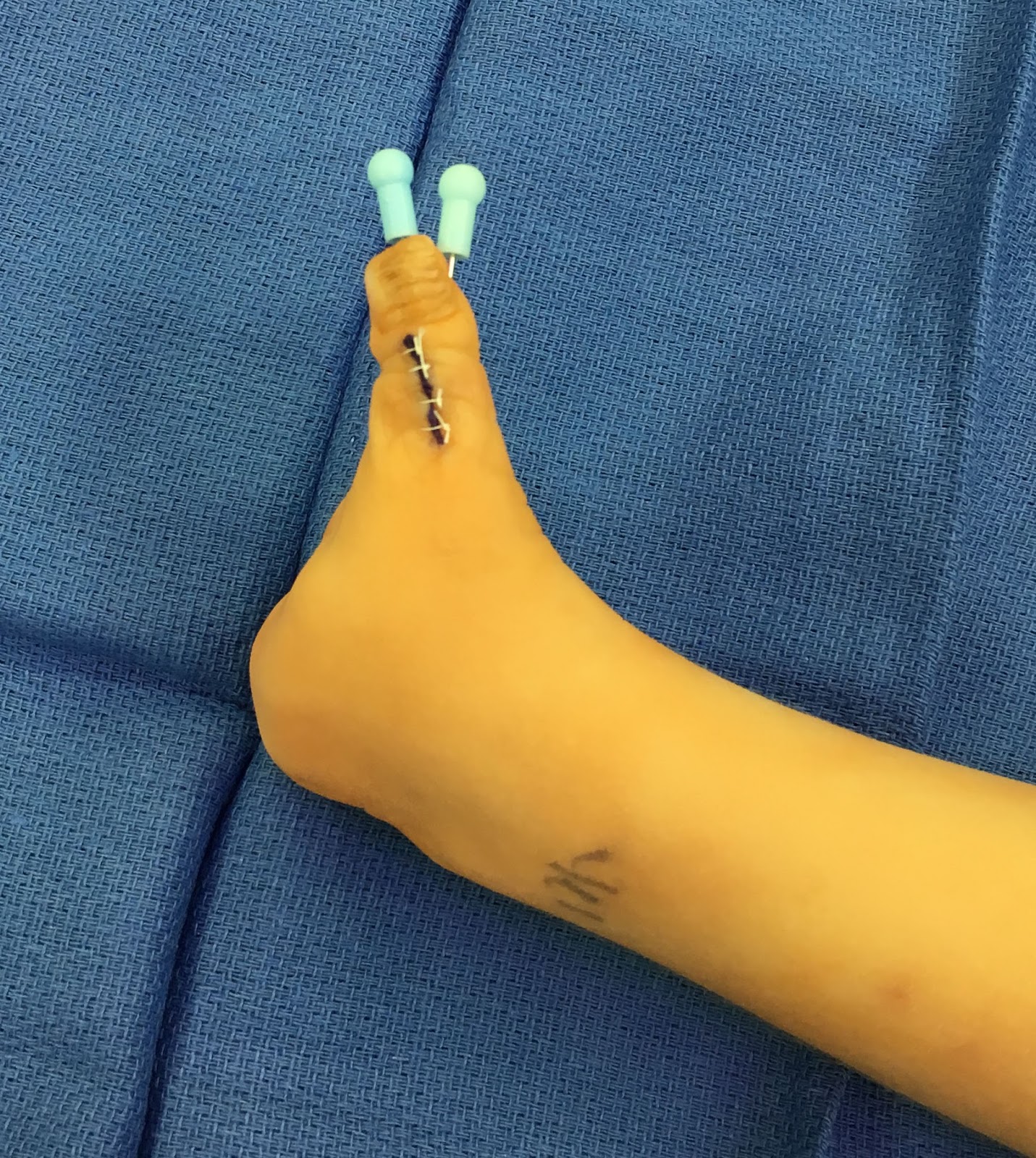 Simple Surgery for Symbrachydactyly | Congenital Hand and Arm ...