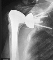 UW Shoulder and Elbow Academy: Reverse total shoulder - dislocations ...