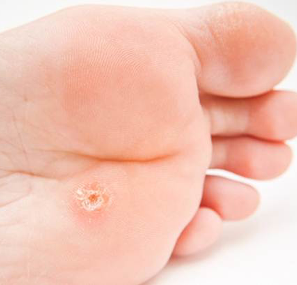 Comment soigner les verrues naturellement? ~ Sport et Santé