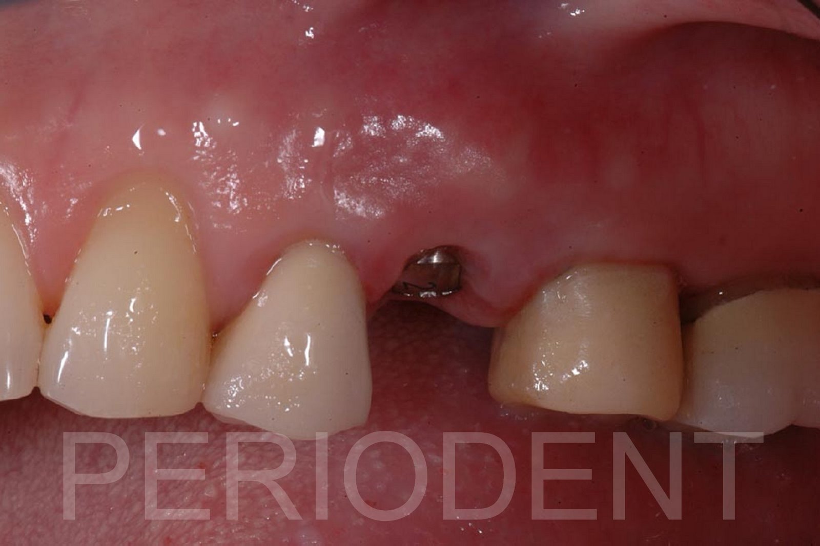 P E R I O D E N T = P E R I O + I M P L A N T: Upper 2nd Premolar ...