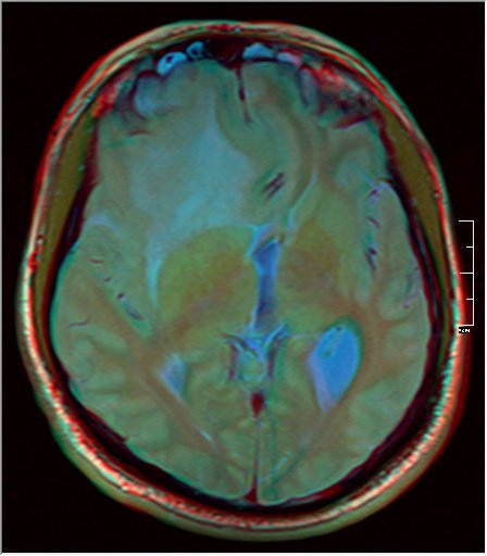 Nevit's blog: Motion atrifacts, Color Brain MRI