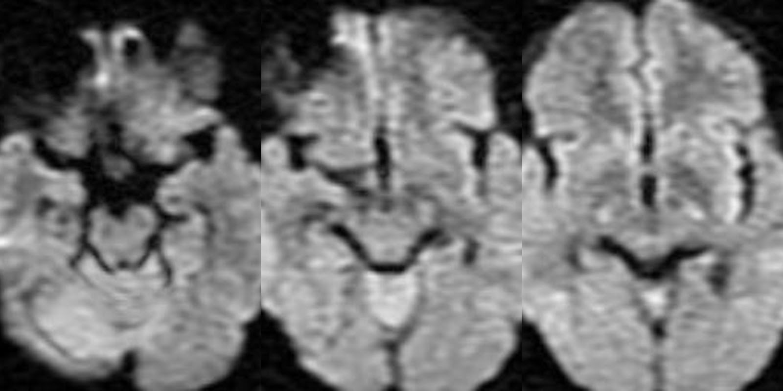 saka: encephalitis history