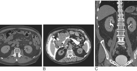 CT OF THE URINARY TRACT: Anatomical relationships of the kidney ...