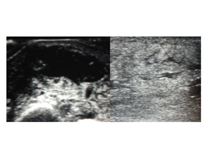 A life at risk: the Emergency Physician: Soft tissue abscess: clinical ...