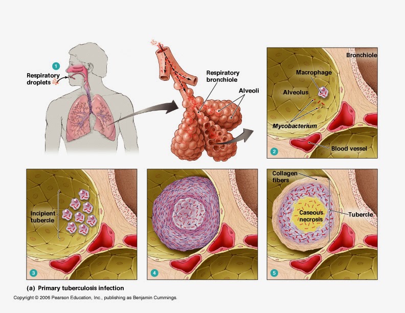 Enfermedades inmunoprevenibles: Tuberculosis