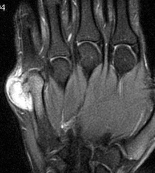 BPOP versus differentials - Sumer's Radiology Blog
